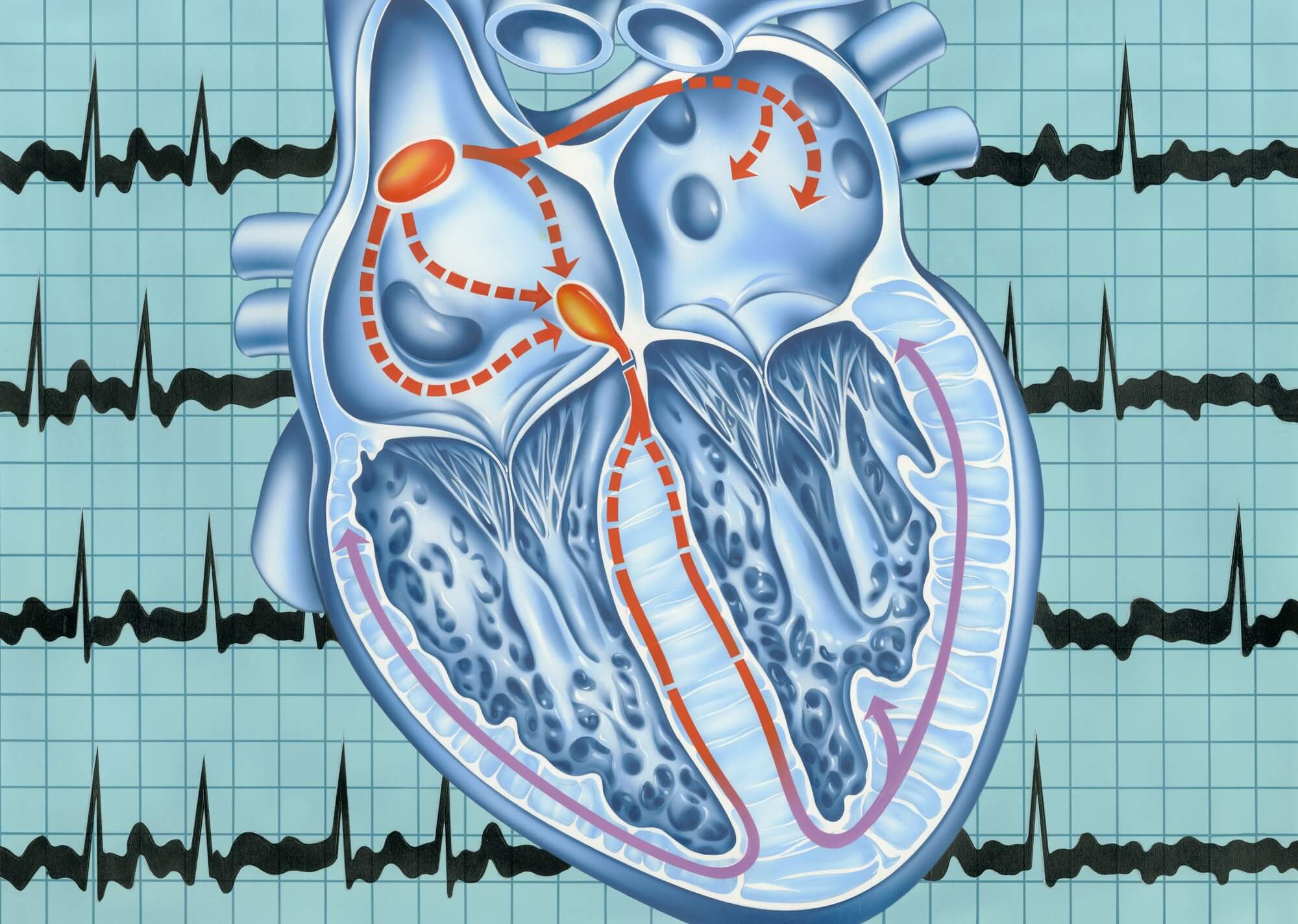 Fibrillation atriale – Insuffisant Cardiologue